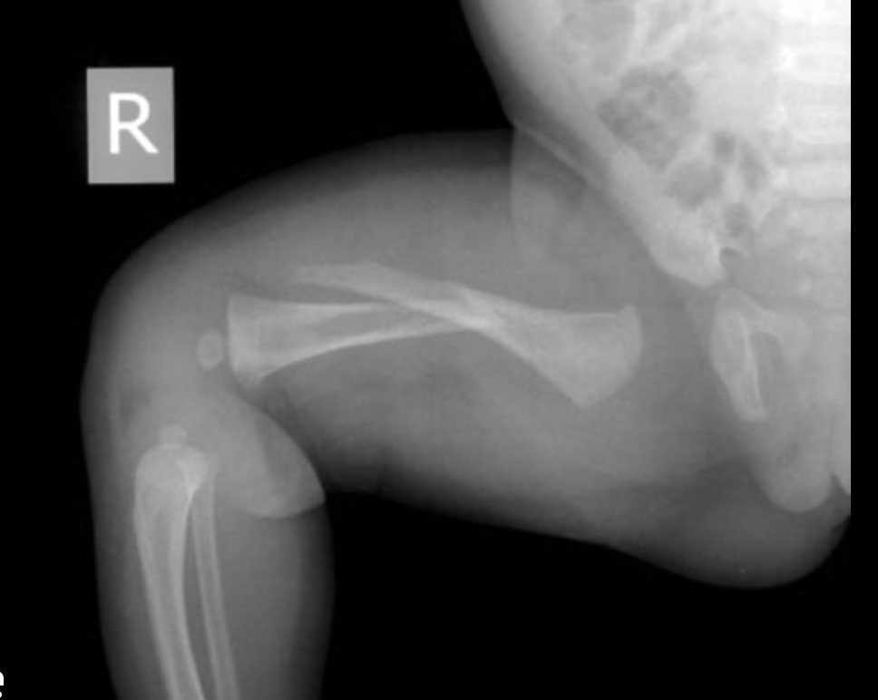 Inflicted Injury in children for UK Paediatric Radiologists ...